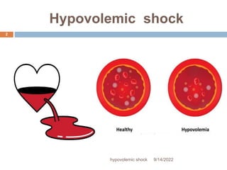 Hypovolemic Shock Pathophysiology