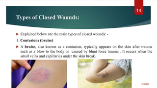 Wound | PPTX