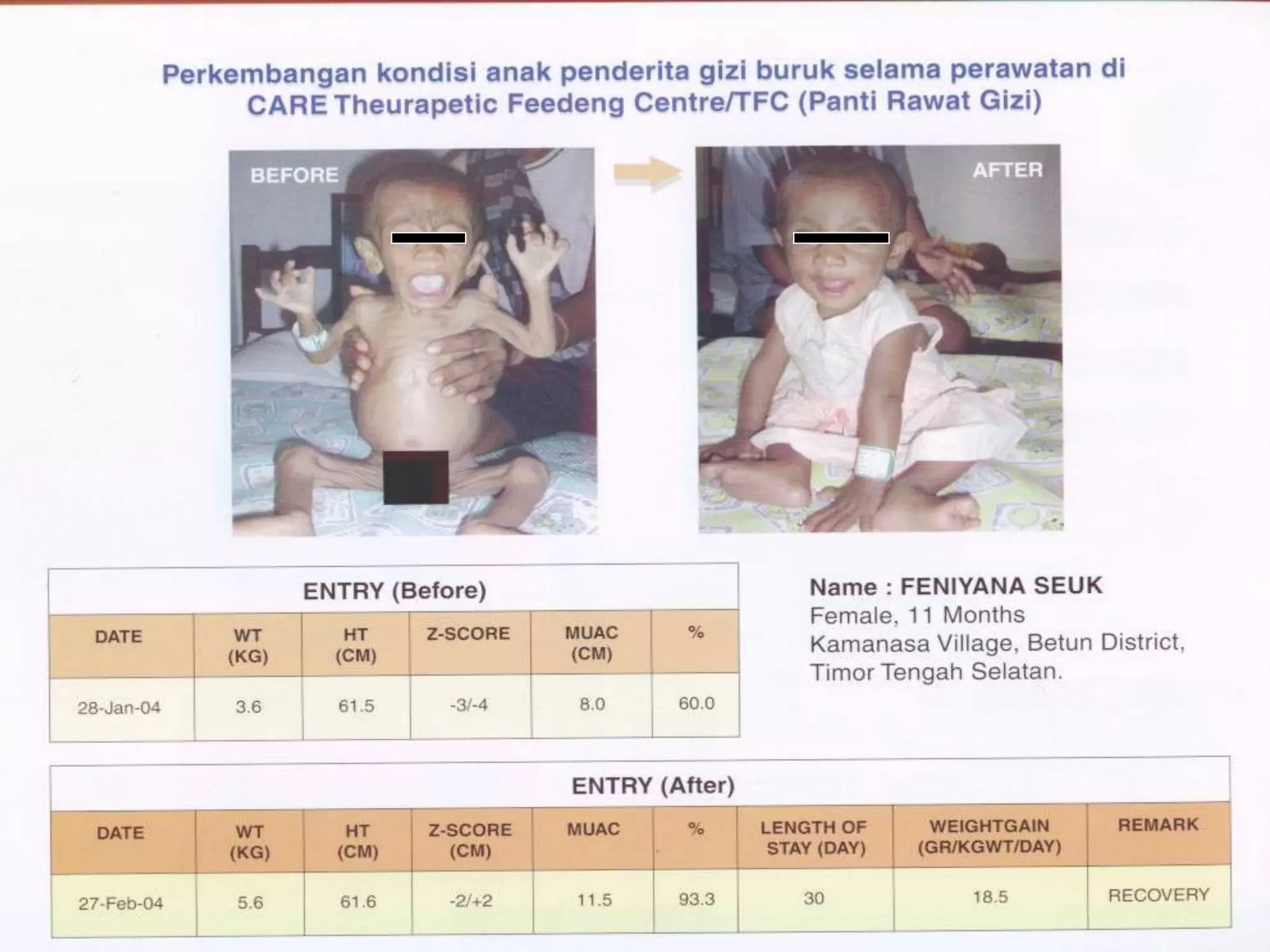 3. Tatalaksana Gizi Buruk.pdf