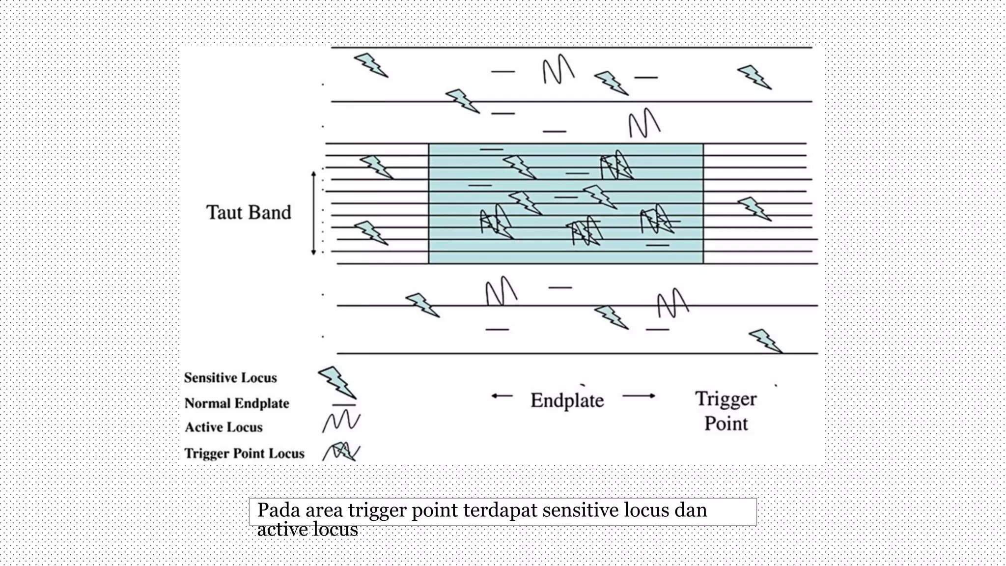 3. Myofascial Trigger Points.pptx