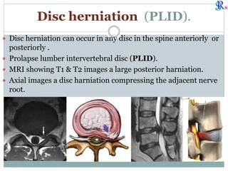 Spine disease rg evaluation.pdf