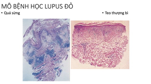 3.Lupus.ppt