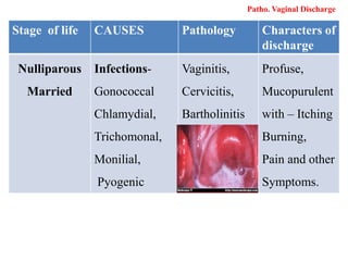 Mucopurulent Vaginal Discharge