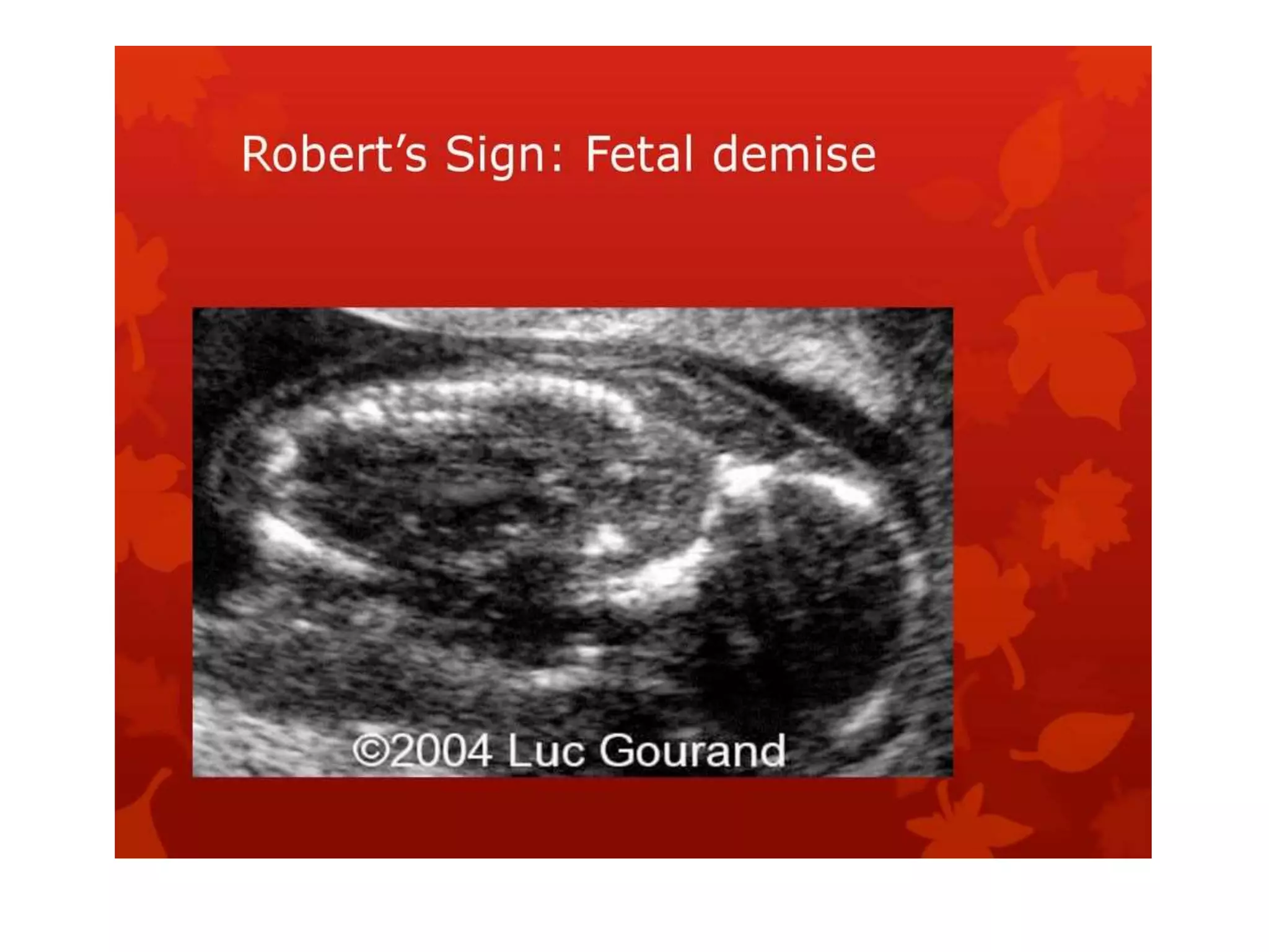 3.Intrauterine Fetal Death (IUFD).pptx