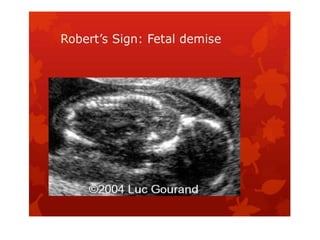 3.Intrauterine Fetal Death (IUFD).pptx