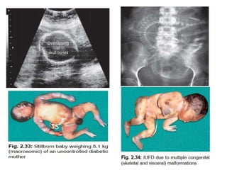 3.Intrauterine Fetal Death (IUFD).pptx