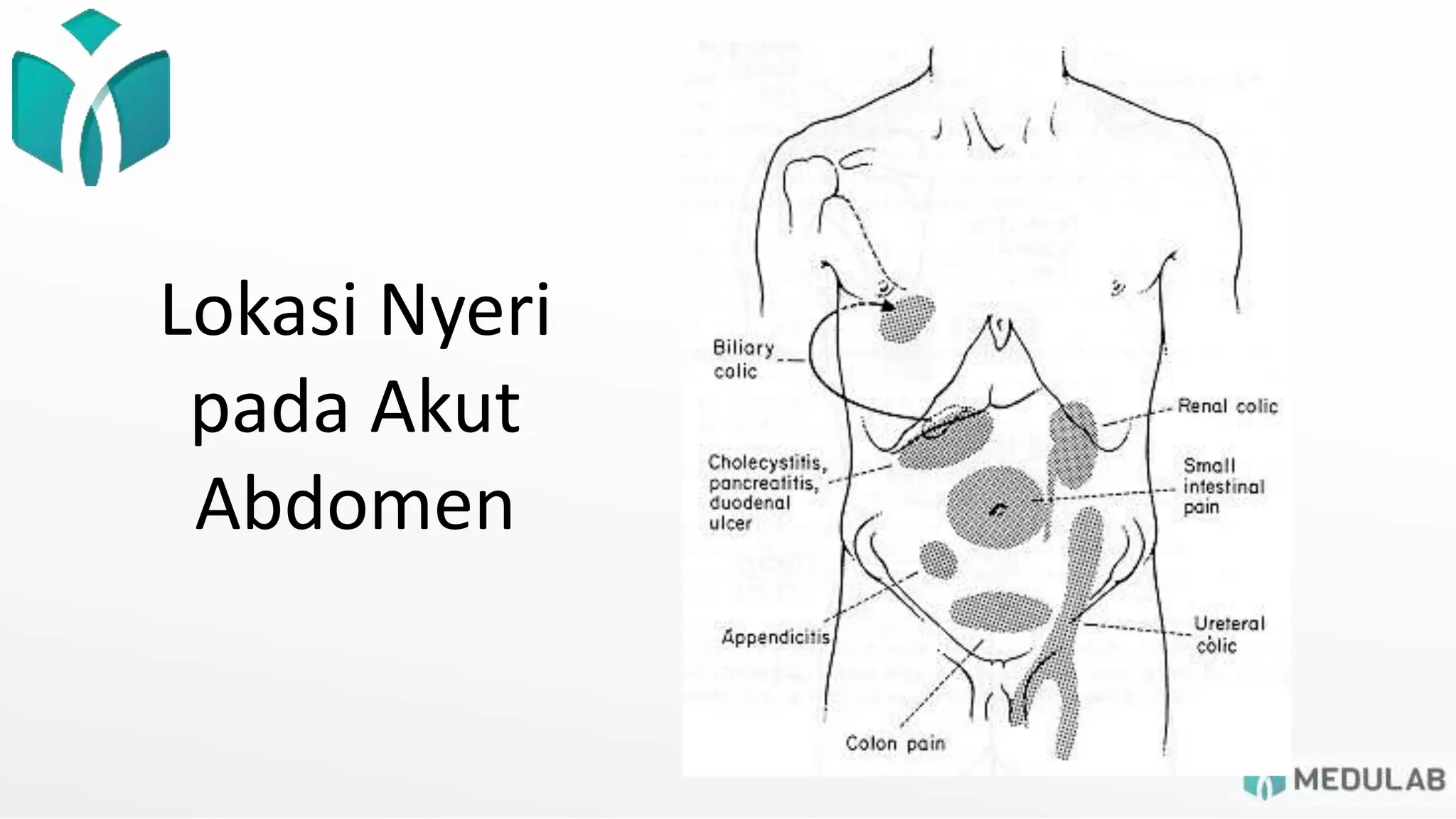 3. AKUT ABDOMEN.pptx