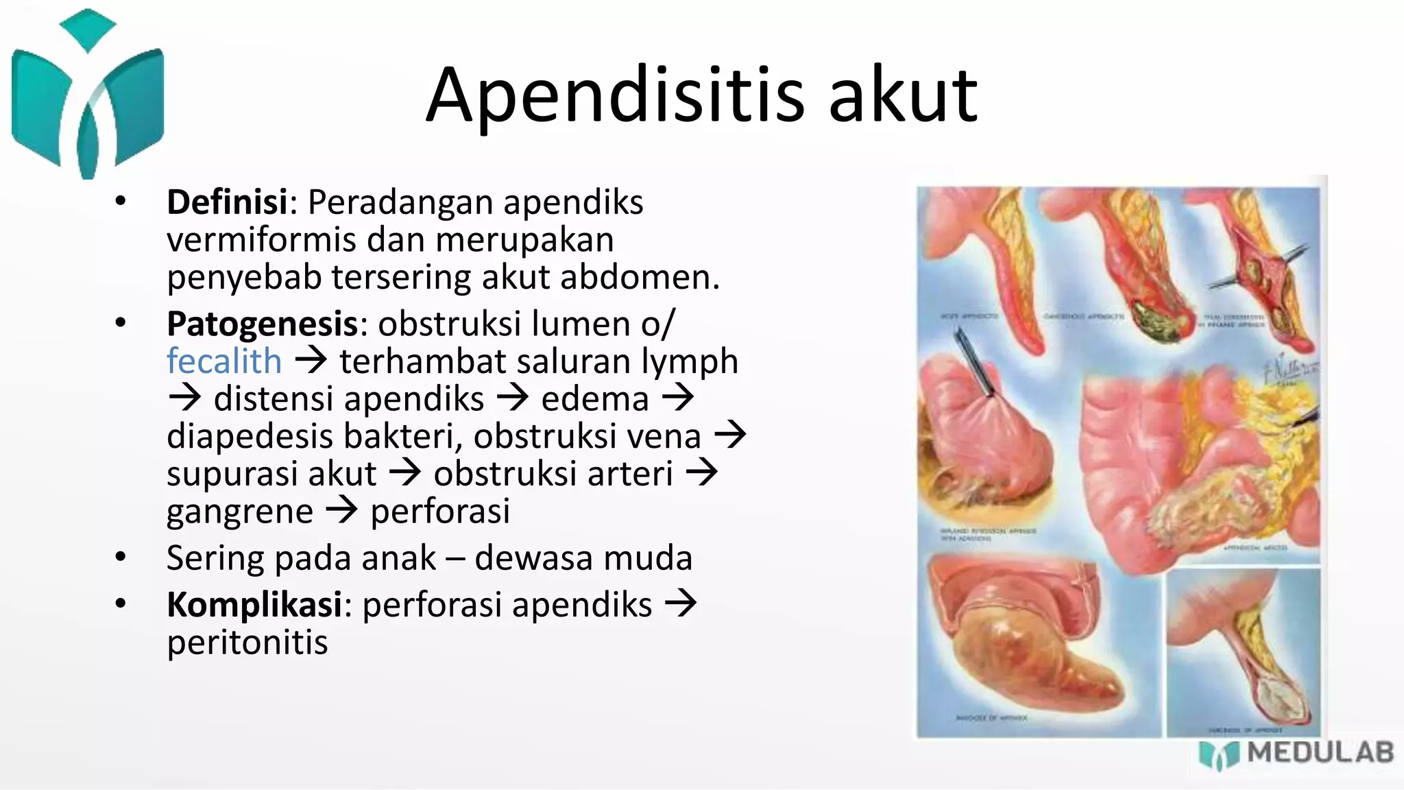 3. AKUT ABDOMEN.pptx