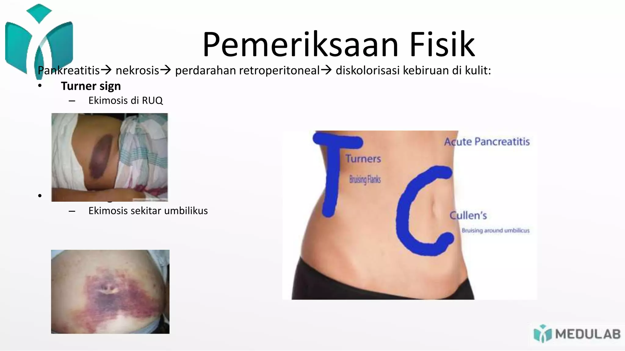 3. AKUT ABDOMEN.pptx