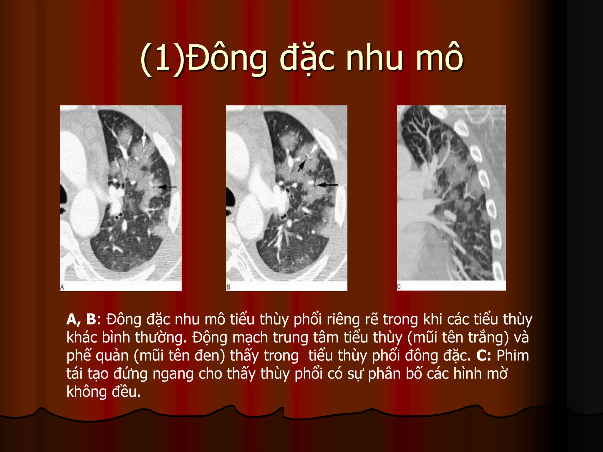3.2. ĐÔNG ĐẶC NHU MÔ, XẸP PHỔI.ppt