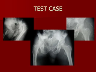 3. dislocation.pptx | Death, Injury, or Military Conflict | Sensitive Topics
