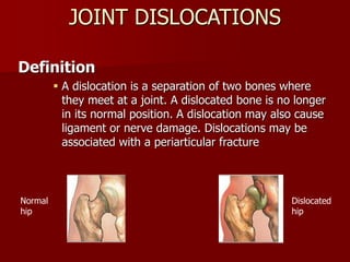 3. dislocation.pptx | Death, Injury, or Military Conflict | Sensitive ...