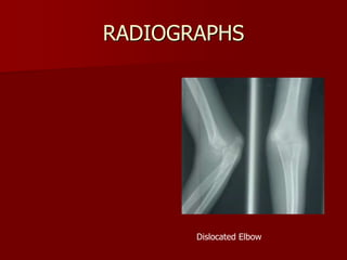 3. dislocation.pptx | Death, Injury, or Military Conflict | Sensitive Topics