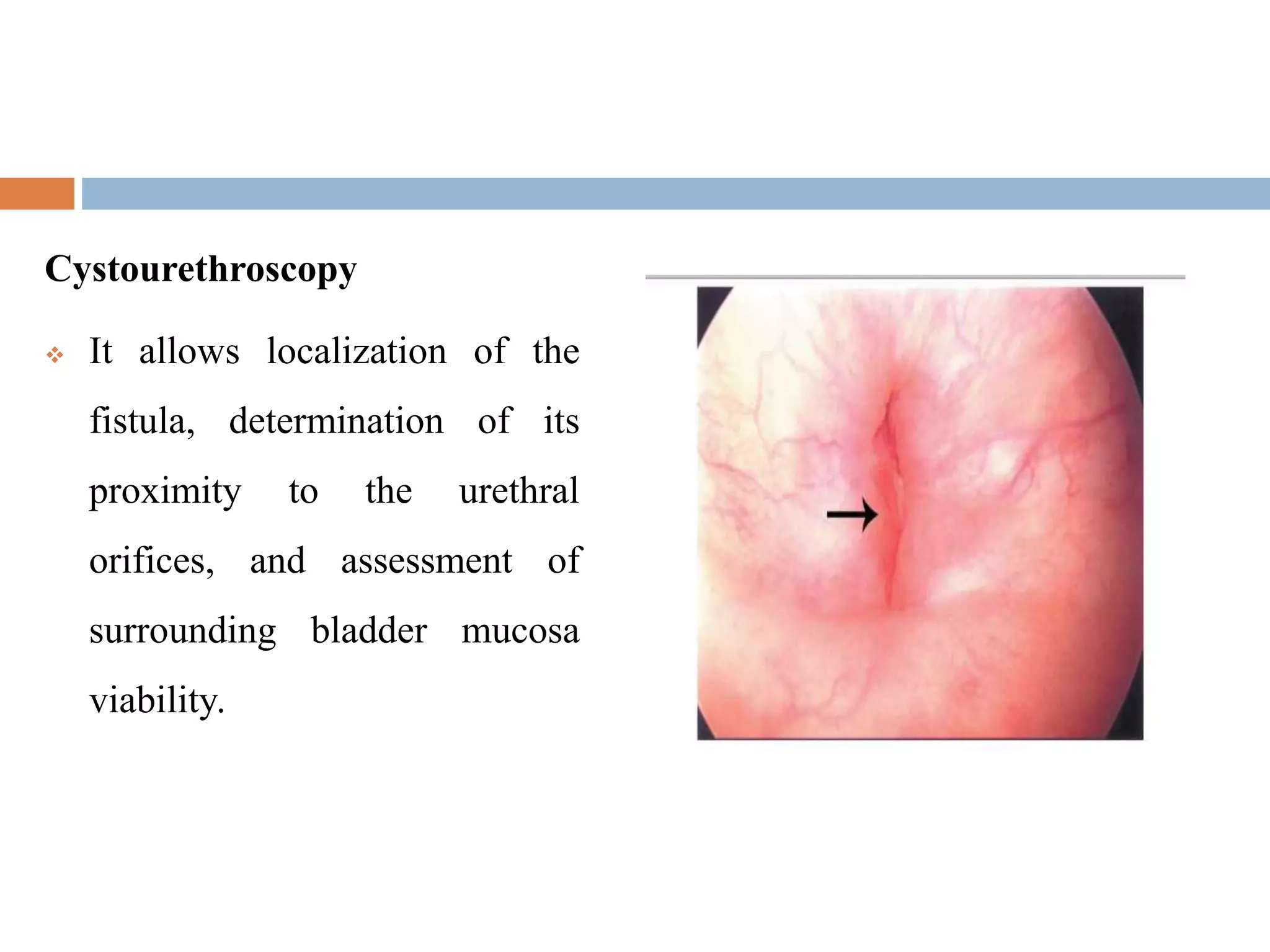 3. Obstetrics fistula.pptx