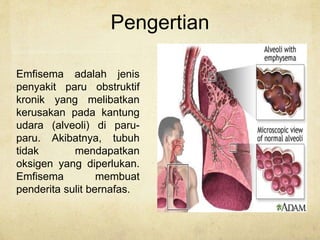 3. emfisema.ppt