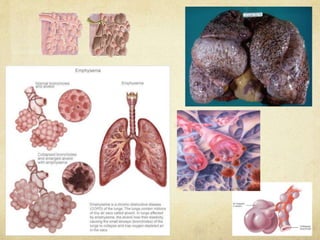 3. emfisema.ppt