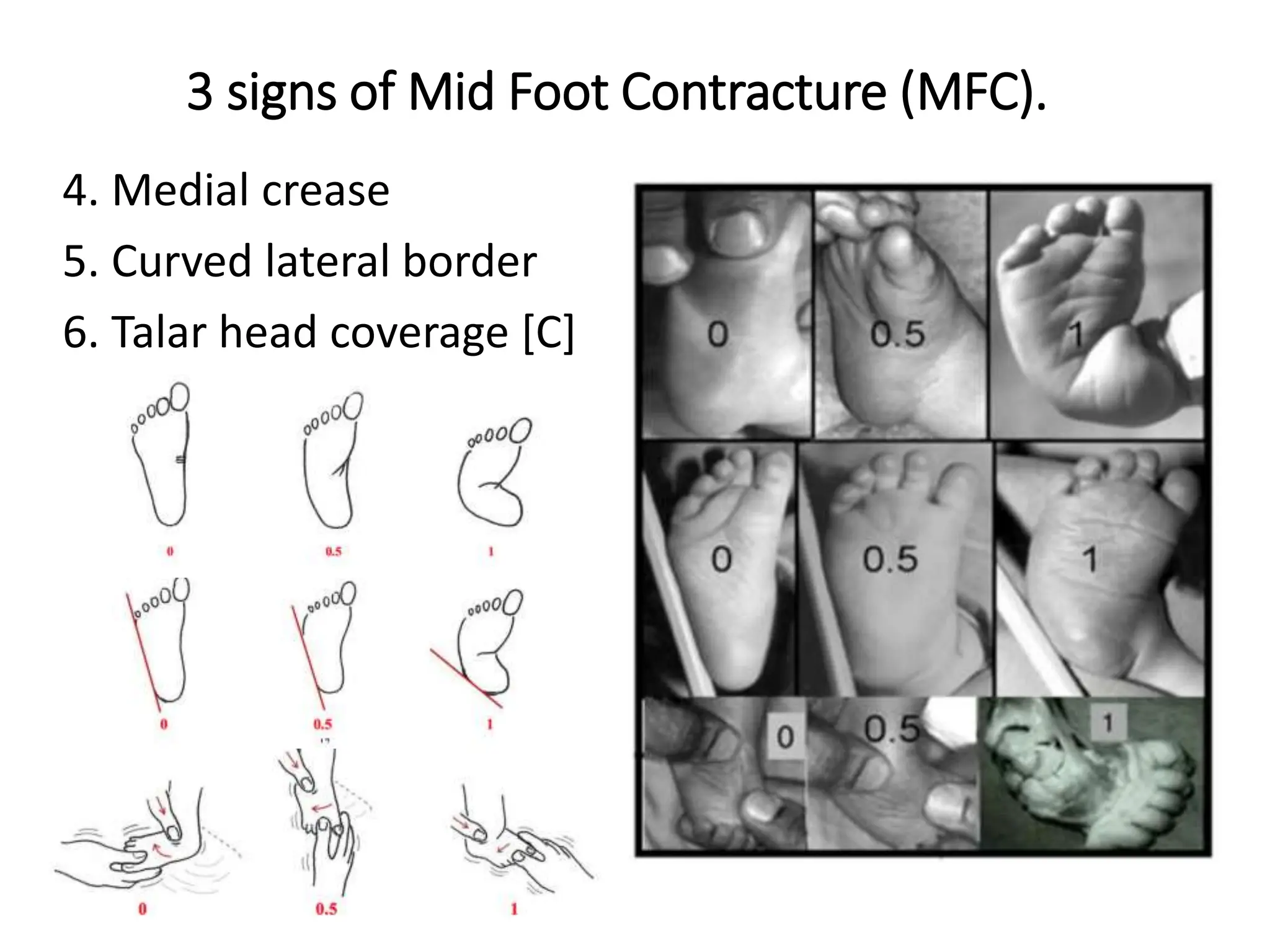 CLUBFOOT Rx Principles AKU.ppt