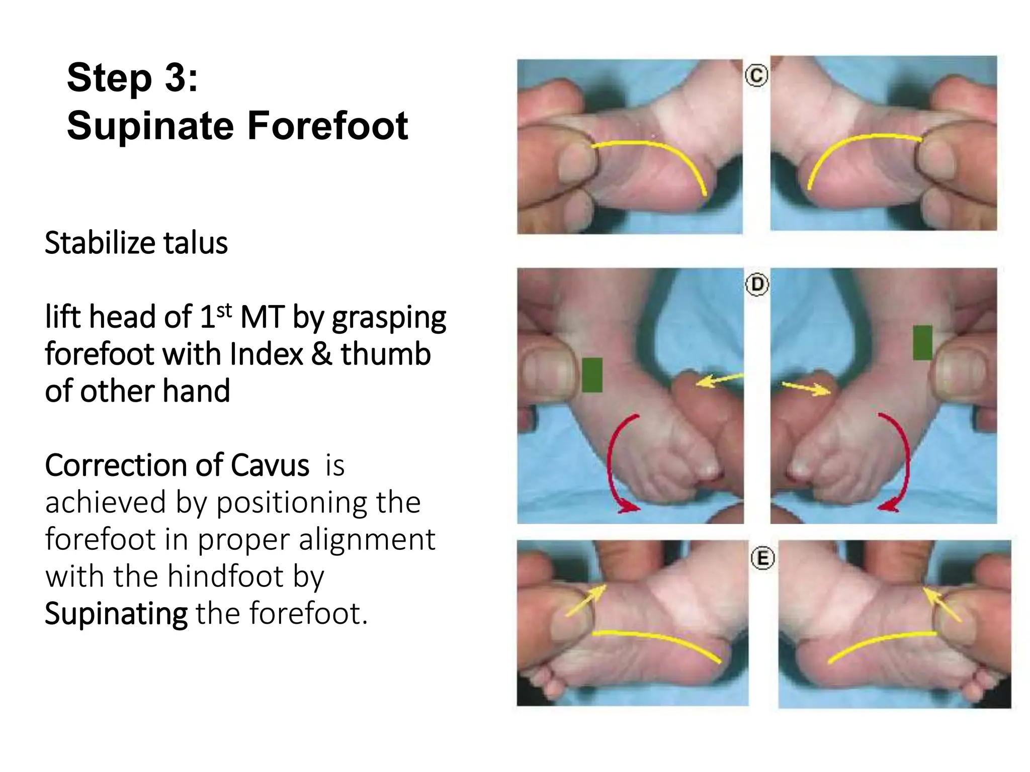 CLUBFOOT Rx Principles AKU.ppt