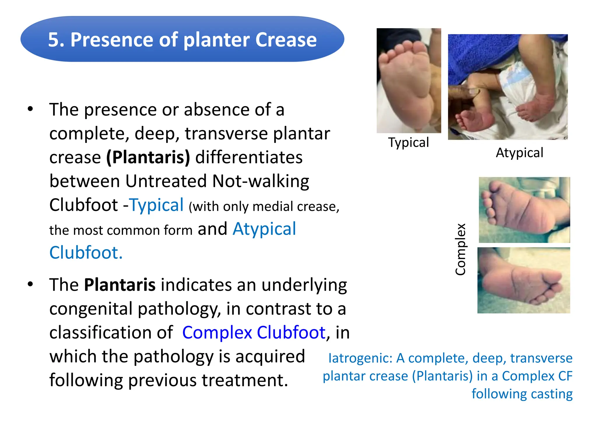 CLUBFOOT Rx Principles AKU.ppt