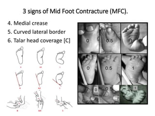CLUBFOOT Rx Principles AKU.ppt