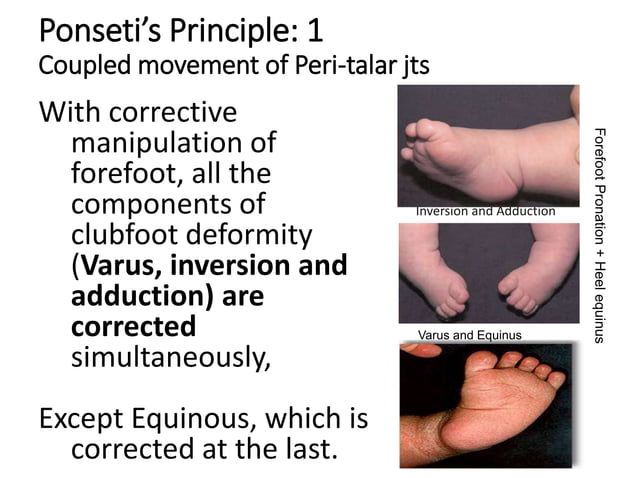 CLUBFOOT Rx Principles AKU.ppt | Death, Injury, or Military Conflict ...