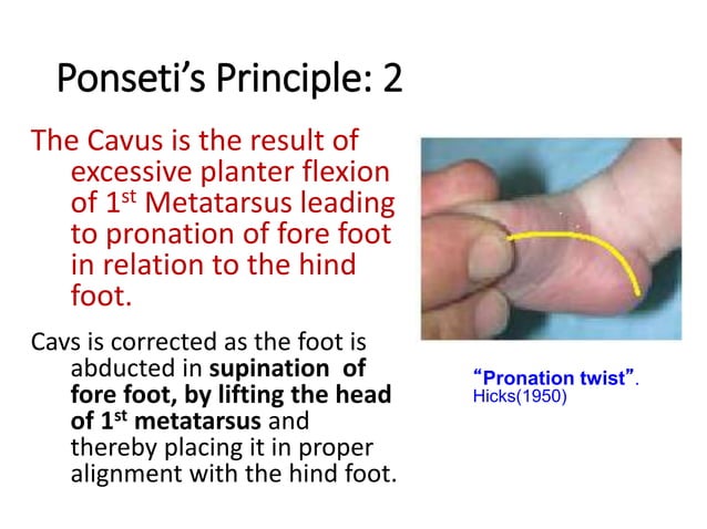 CLUBFOOT Rx Principles AKU.ppt | Death, Injury, or Military Conflict ...