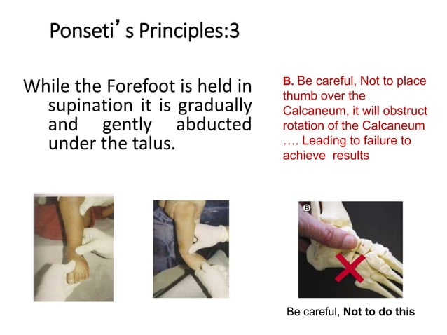 CLUBFOOT Rx Principles AKU.ppt | Death, Injury, or Military Conflict ...