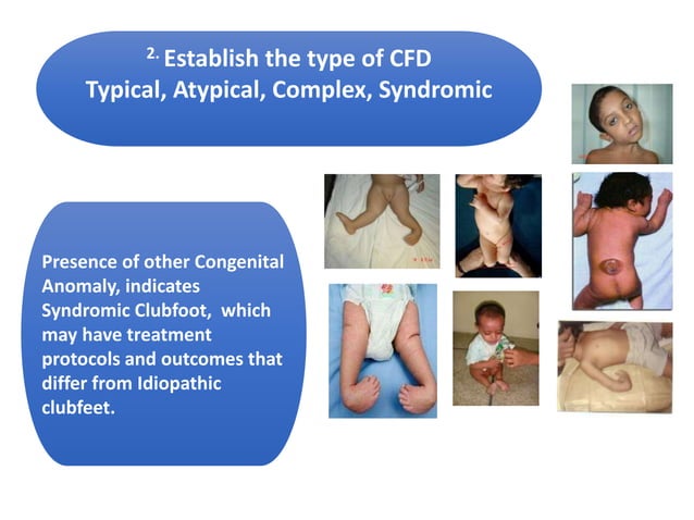 CLUBFOOT Rx Principles AKU.ppt | Death, Injury, or Military Conflict ...