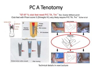 CLUBFOOT Rx Principles AKU.ppt