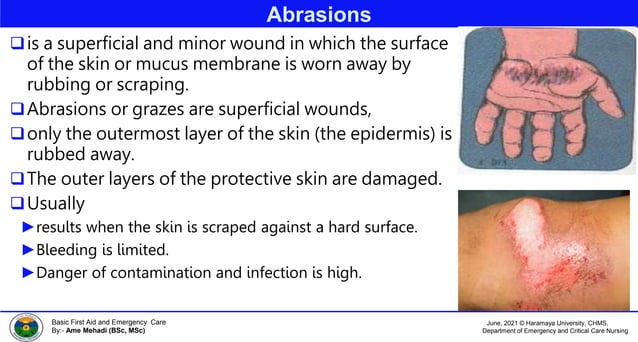 3. Wounds & Bleeding (2).pptx