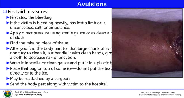 3. Wounds & Bleeding (2).pptx