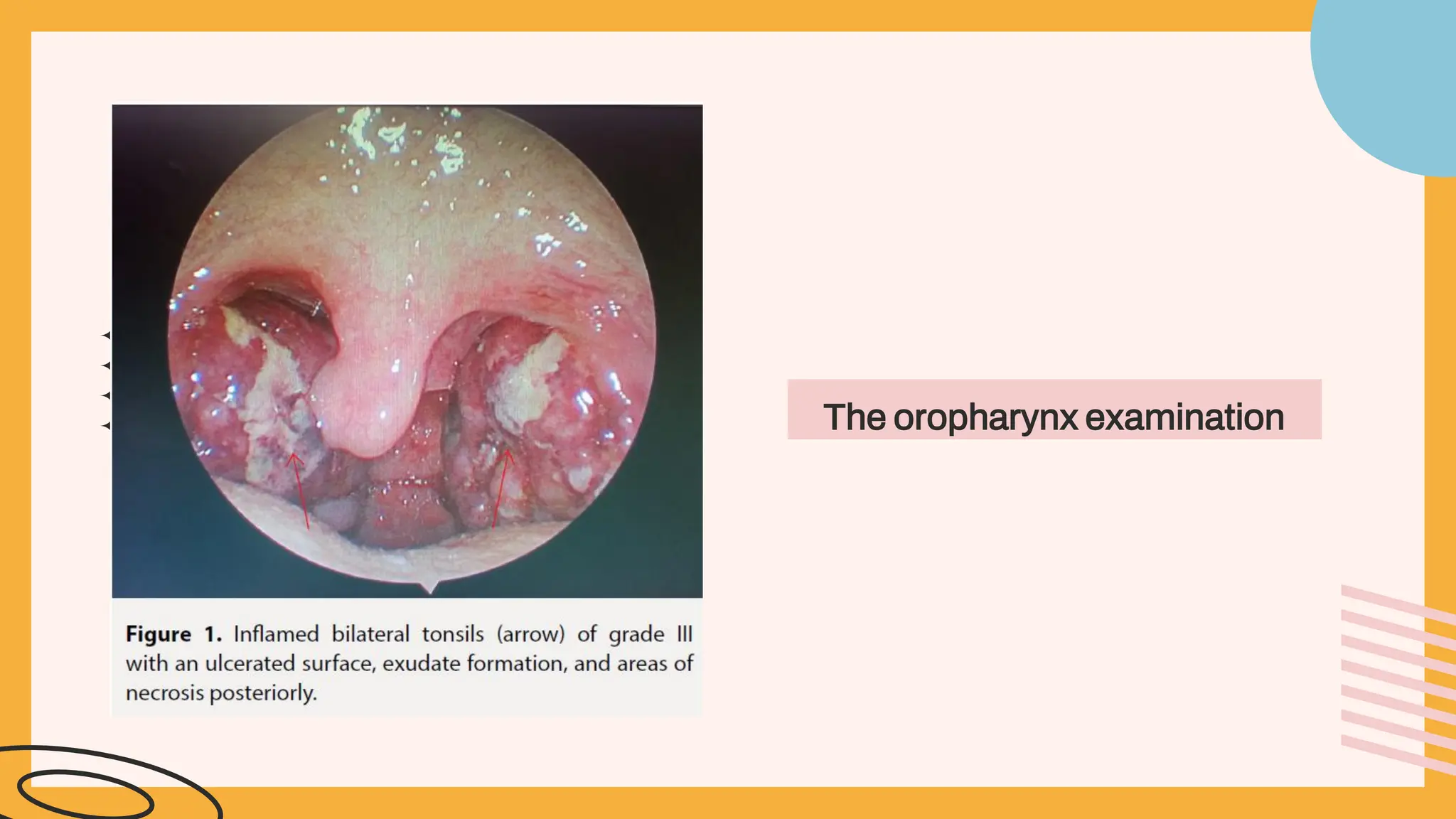 3. PPT JURNAL THT- T-Cell Acute Lymphoblastic Leukemia Camouflaged as Acute Tonsillitis.pdf