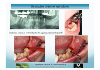 3.4_Extraccion_de_restos_radiculares._Extracciones_seriadas (1).pdf