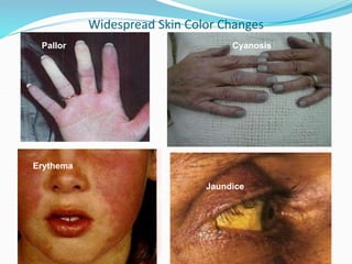 3.Skin, Hair & Nail Assessment.ppt Nursing | PPT