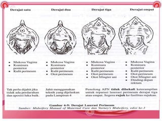 3. HEACTING LASERASI.ppt pada persalinan | PPT