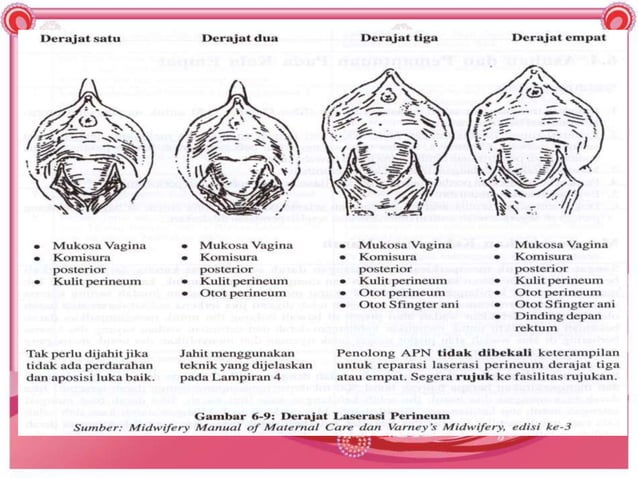 3. HEACTING LASERASI.ppt pada persalinan | PPT