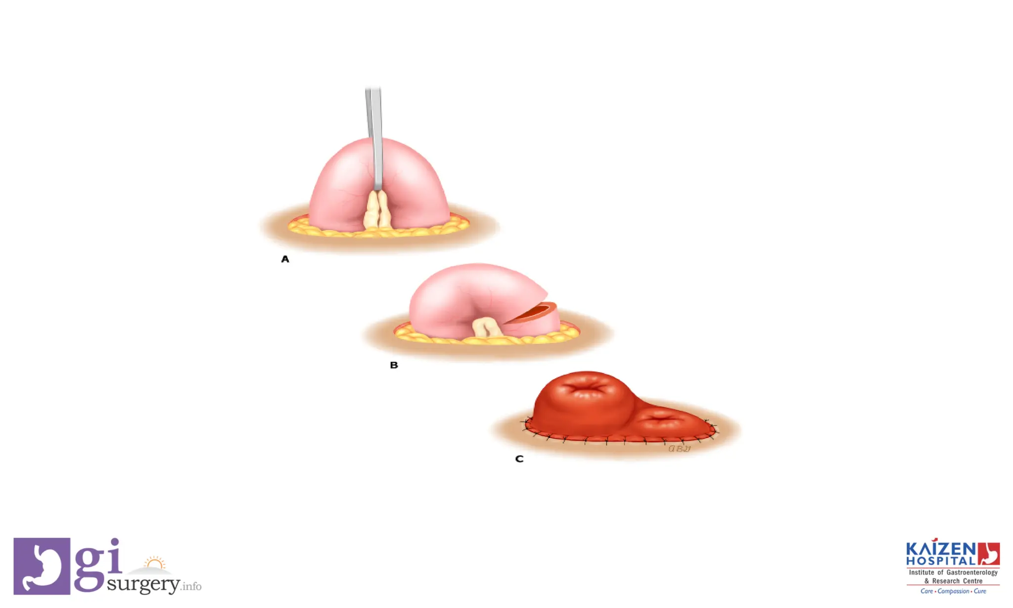 3.6 Stoma techniques of construction.pdf