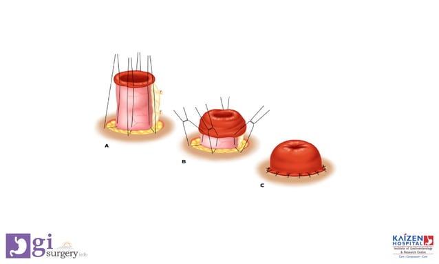 3.6 Stoma techniques of construction.pdf