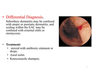 Otitis externa on human ear Pathophysiology | PPTX