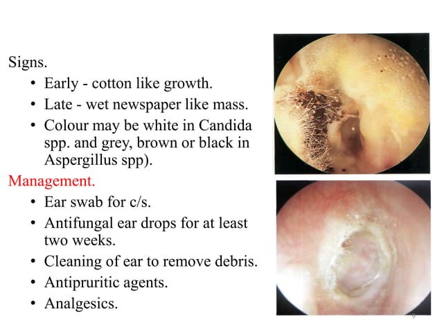 Otitis externa on human ear Pathophysiology | PPTX | Ear, Nose and Throat Conditions | Diseases ...