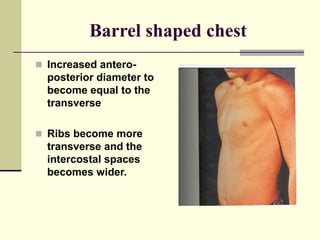 3. Chest examination.ppt ehbeiebeiwbbwbsiehbe | PPT