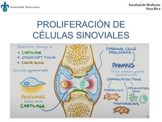 3. Artritis reumatoide FACULTAD DE MEDICINA UV.pptx