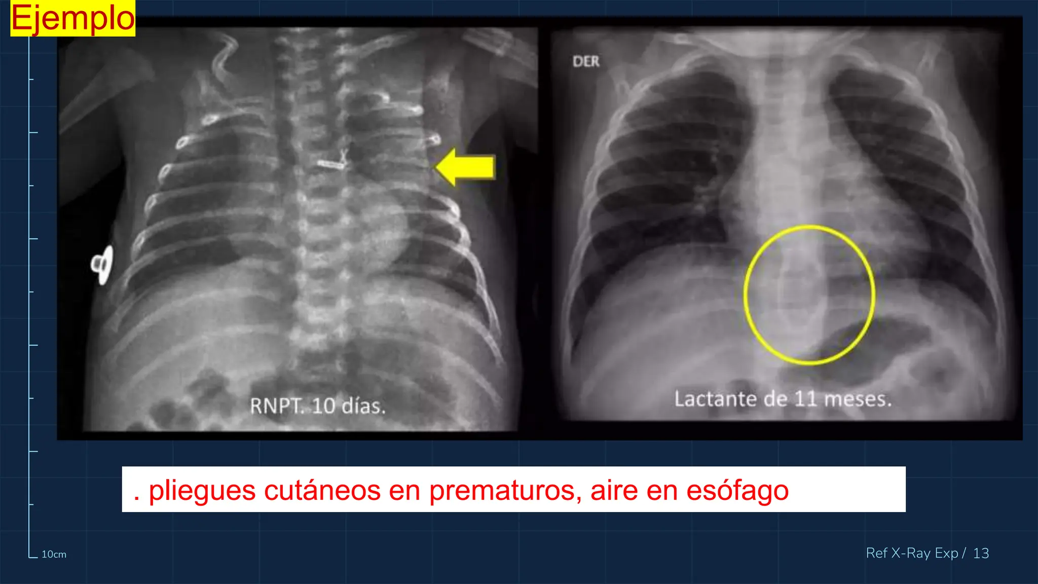 IMAGENOLOGIA DE TORAX EN DIFERENTES PROYECCIOENS | PPTX
