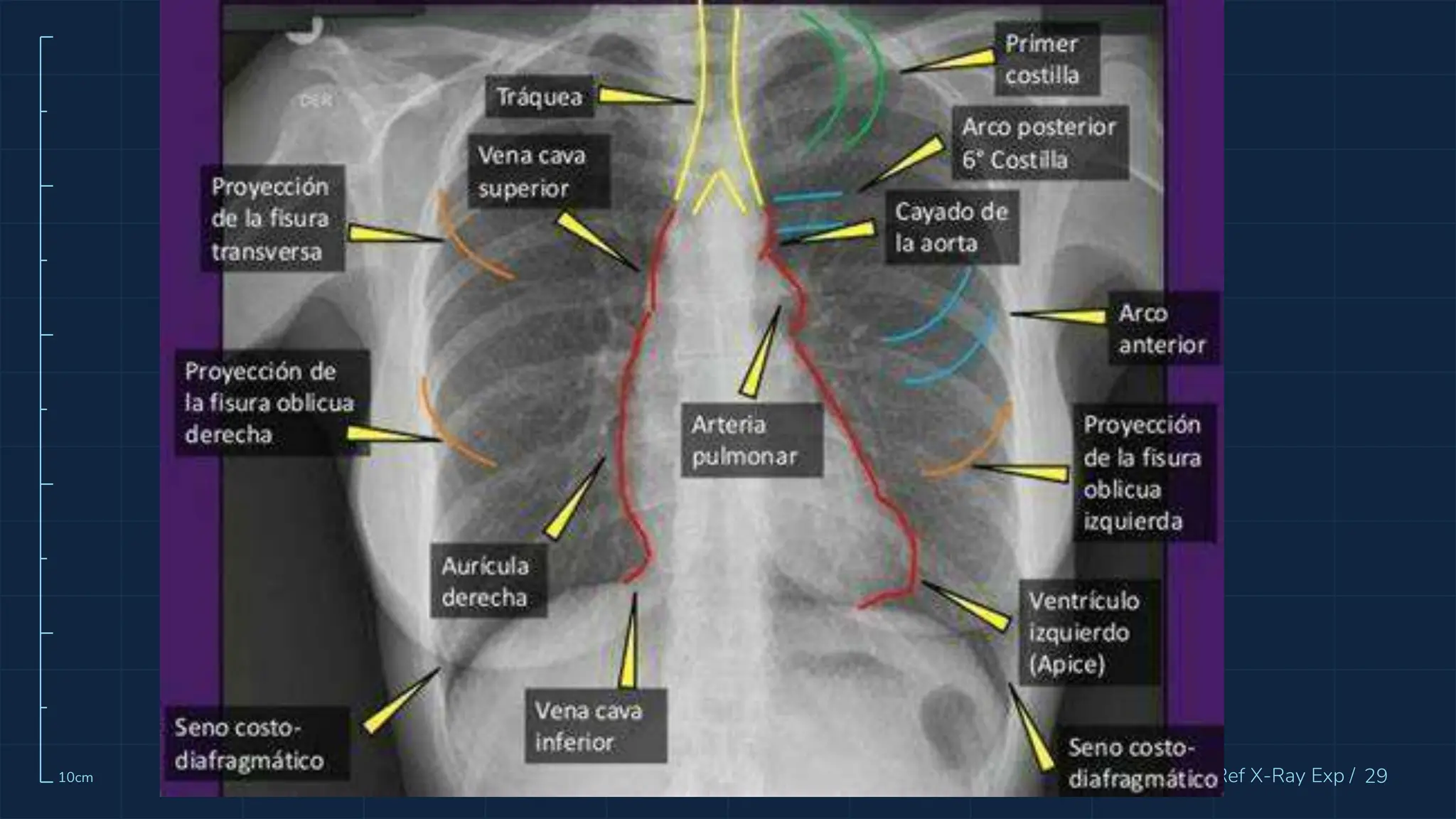 IMAGENOLOGIA DE TORAX EN DIFERENTES PROYECCIOENS | PPTX