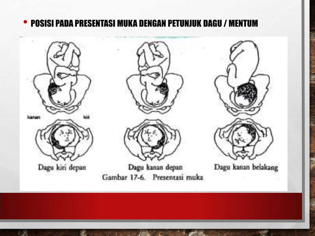 Malposisi-Malpresentasi obstetri terbaru.pdf