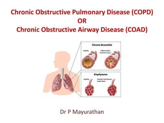 Chronic Obstructive Pulmonary Disease / COPD | PPT