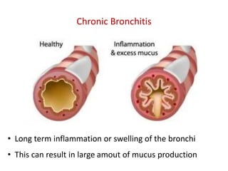 Chronic Obstructive Pulmonary Disease / COPD | PPT
