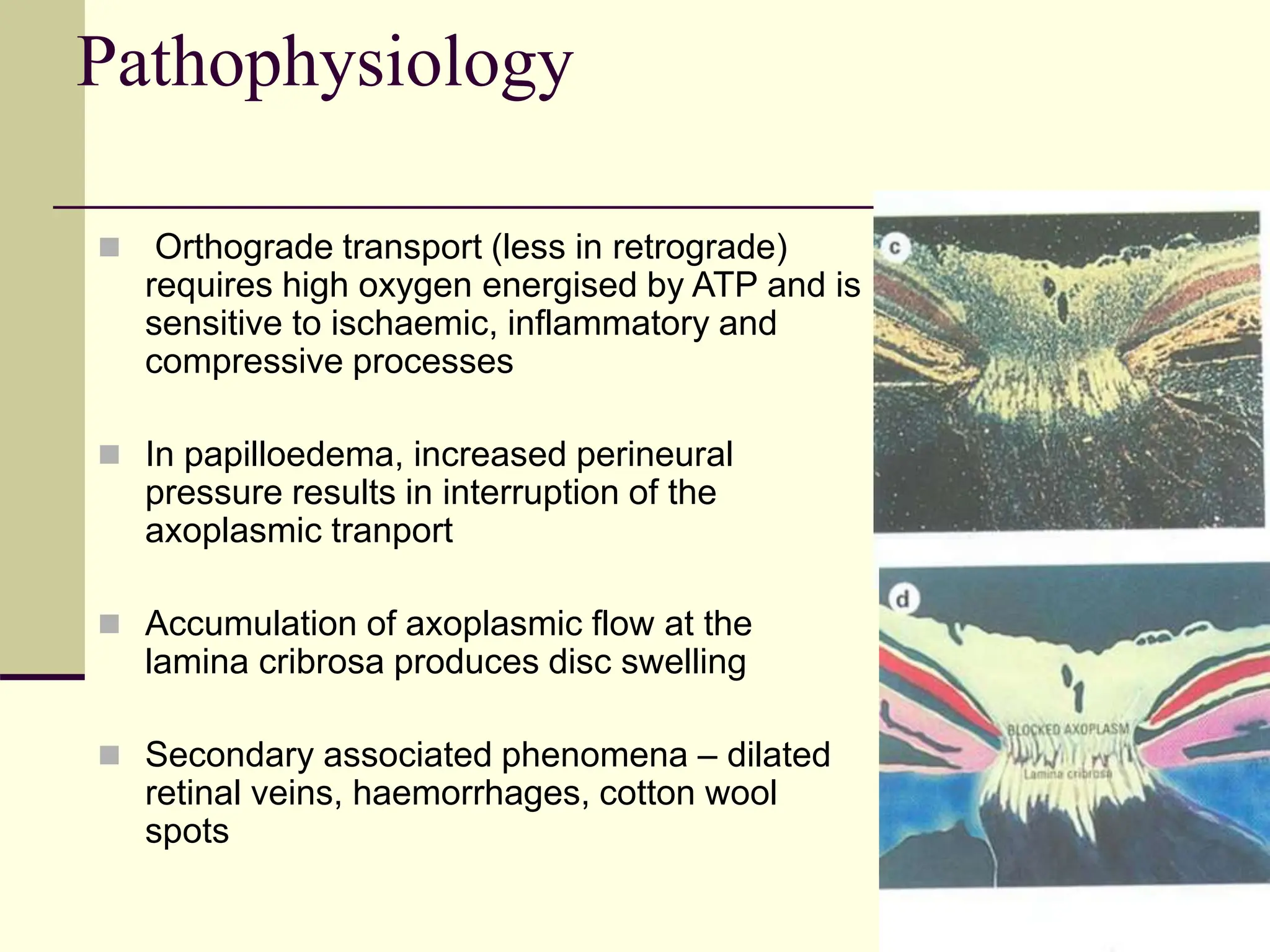 3. PAPILLOEDEMA Neuro Ophthalmology0.ppt