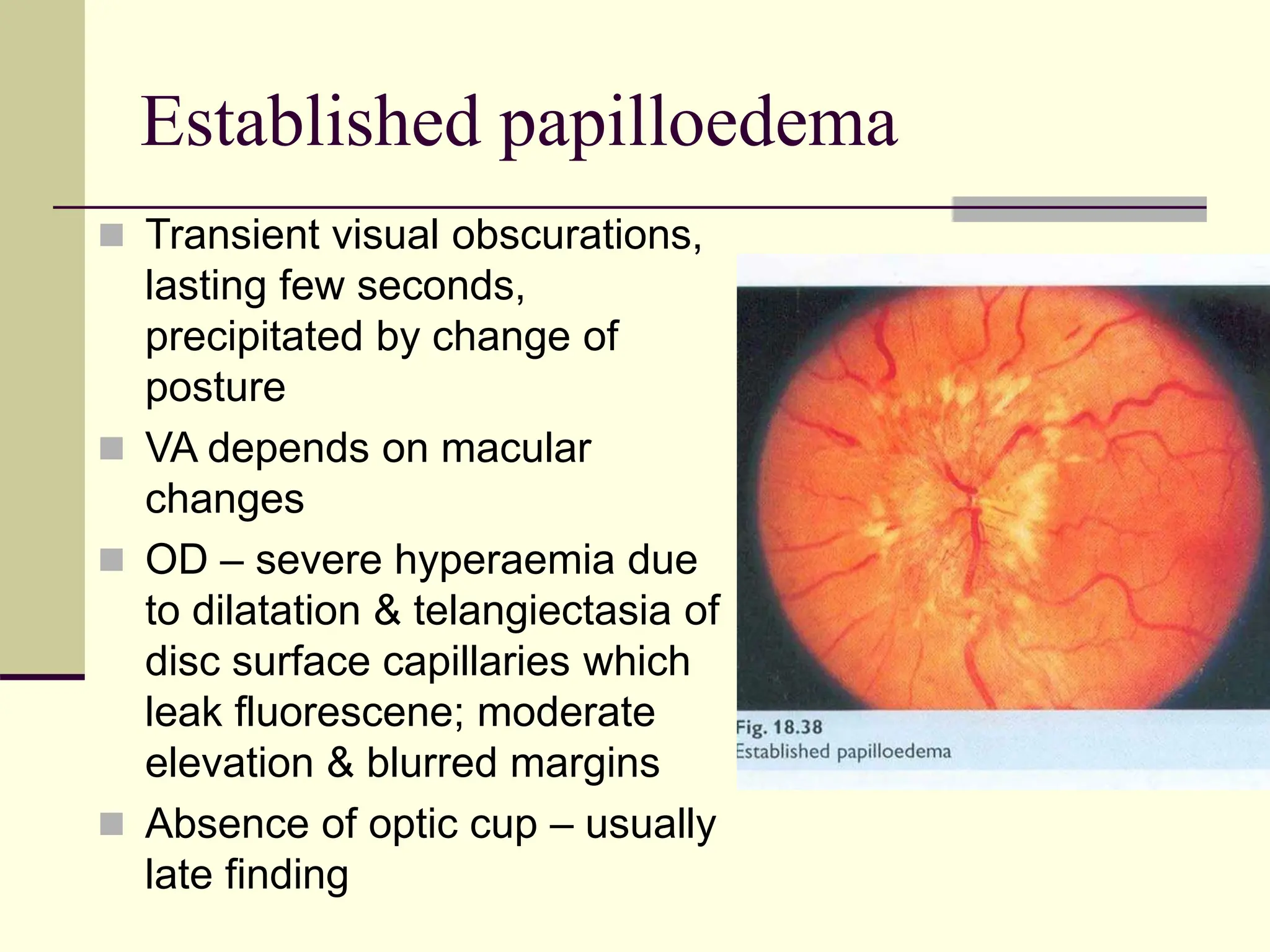 3. PAPILLOEDEMA Neuro Ophthalmology0.ppt
