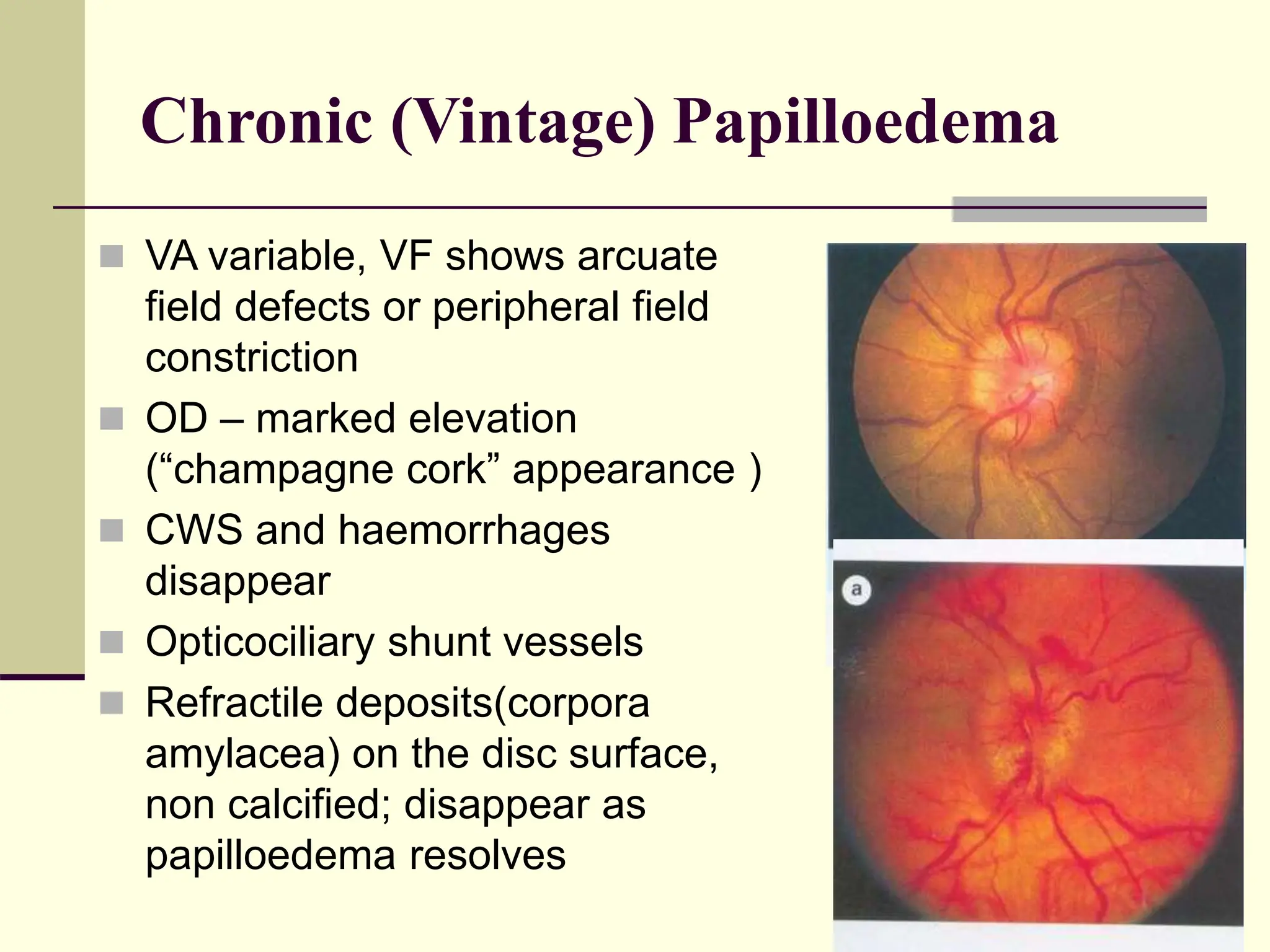 3. PAPILLOEDEMA Neuro Ophthalmology0.ppt